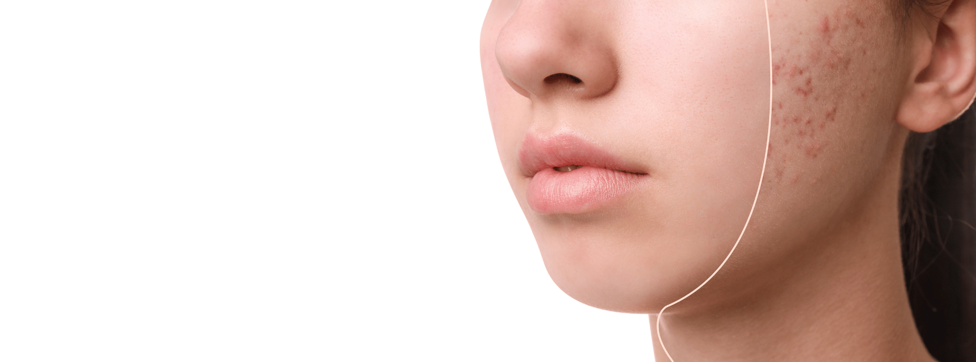 AviClear Acne Laser Treatment in NYC | SkinCeuticals SkinLab by Tribeca ...