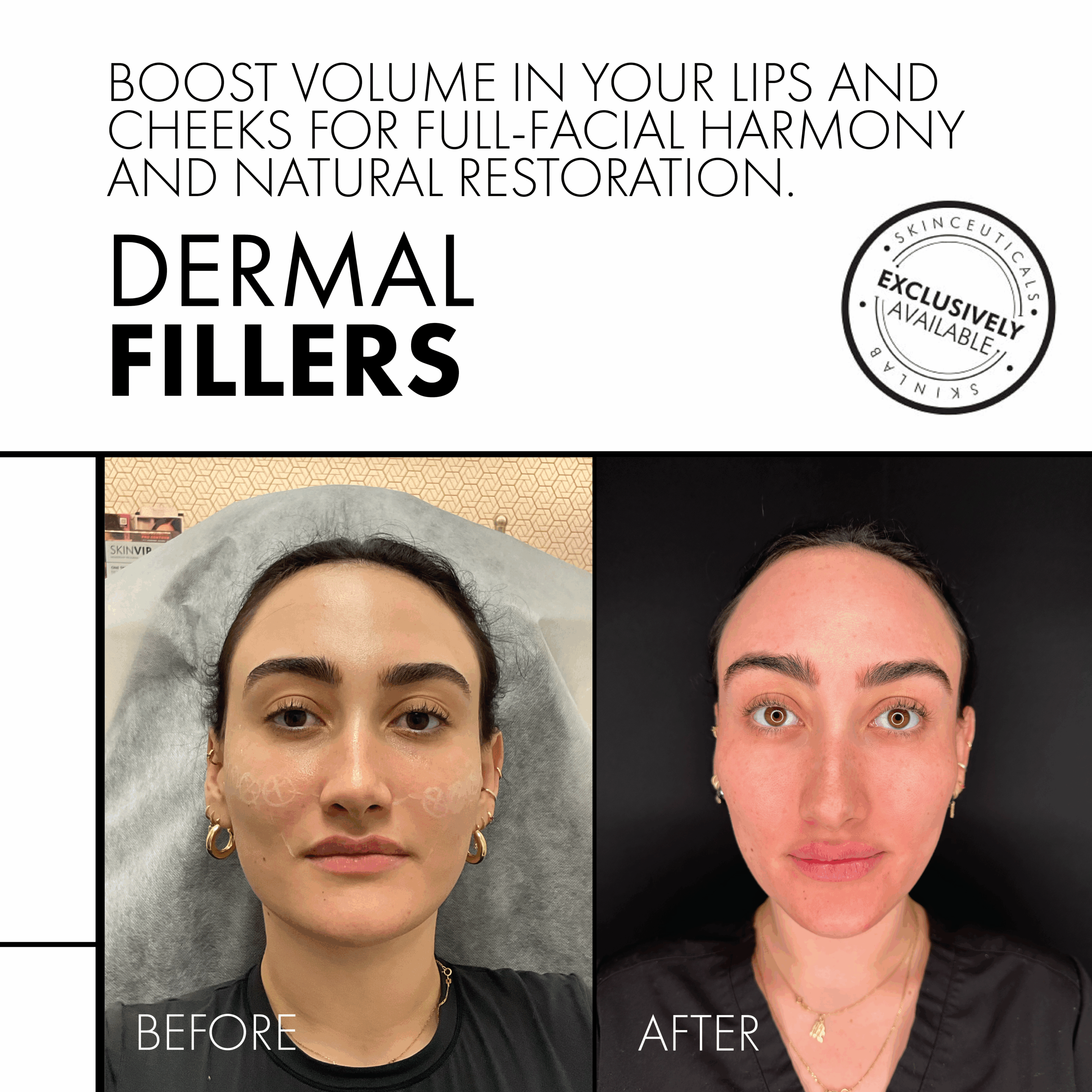 A Comprehensive Guide to Lip Filler Treatments at SkinLab NYC